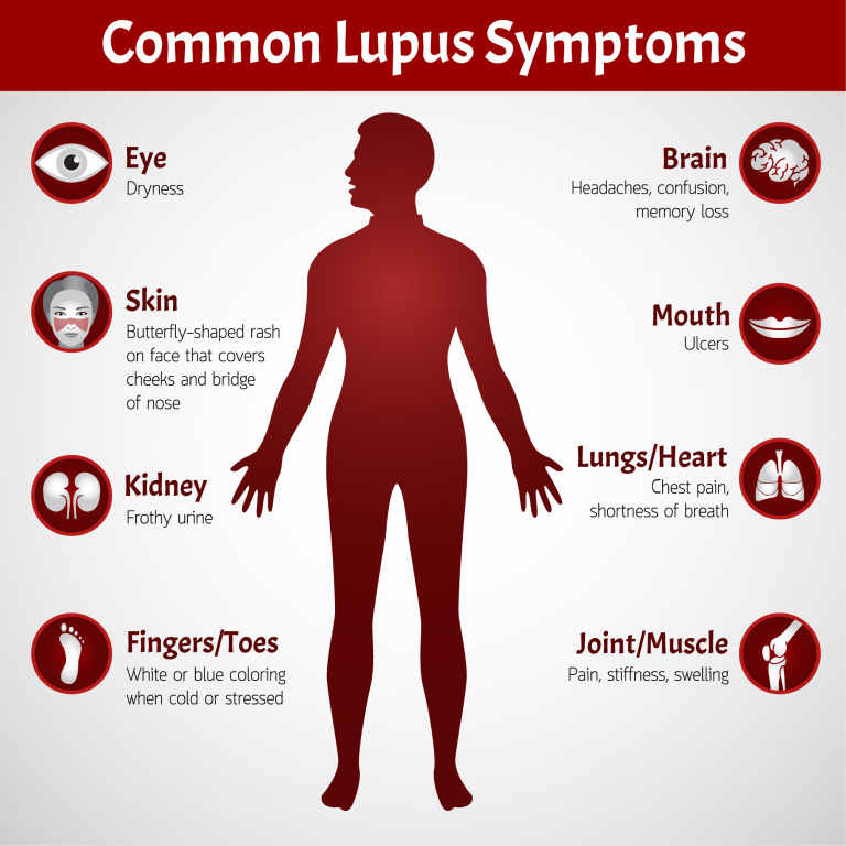Lupus | APS Foundation of America, Inc.